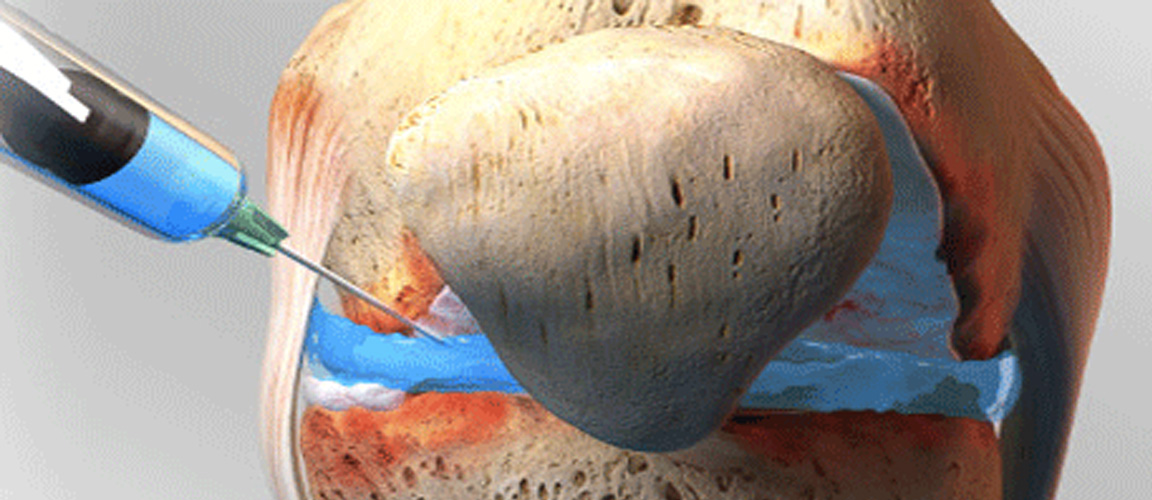 PRF in Orthopedic Surgery